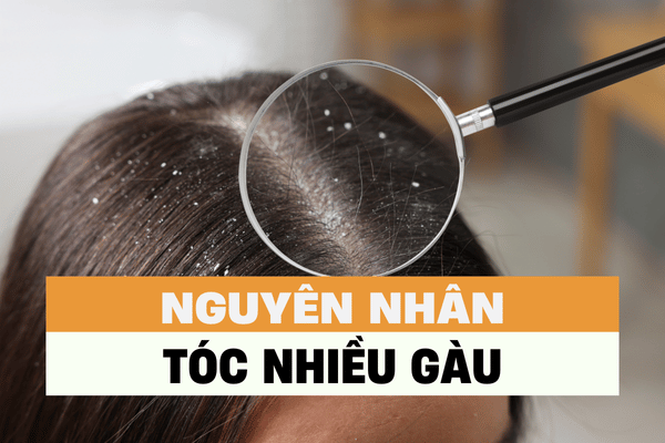 Nguyên nhân nào khiến tóc có nhiều gàu?
